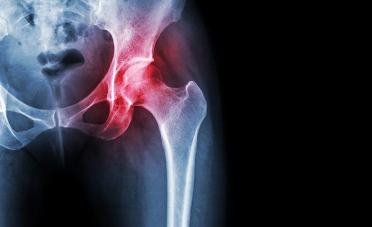 Common Hip Injuries, Symptoms & Treatment Common Hip Injuries, Symptoms & Treatment